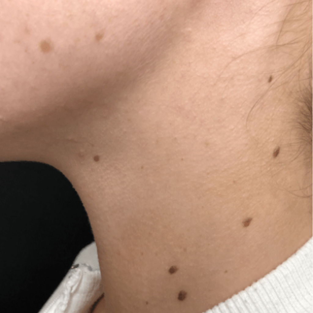 Luxeveria Mole Removal Cream – Safe, Gentle, Scar-Free Results